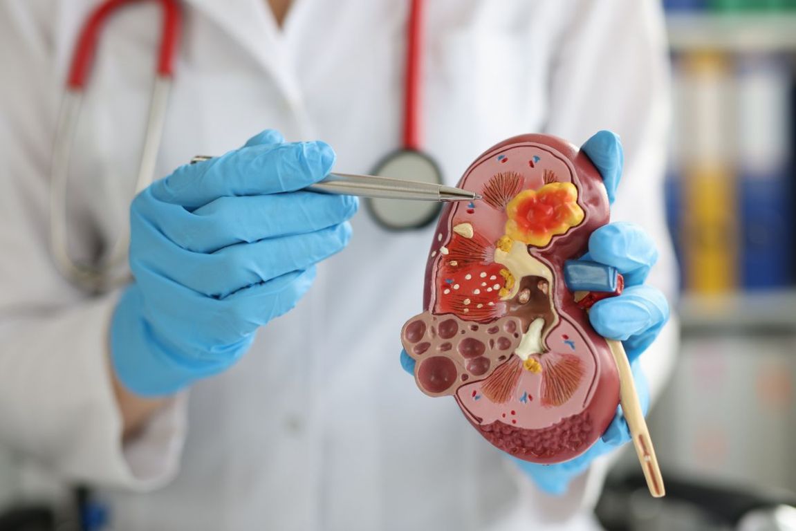 Trattamento dei calcoli renali - urologoandrologoraimoldi.it