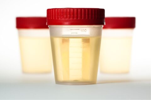 Sangue nelle urine: quando preoccuparsi e quali sono le possibili cause